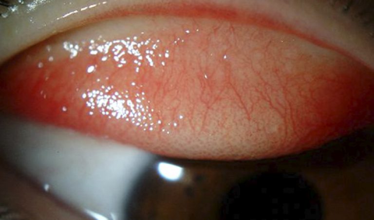 Conjuntivitis alérgica – Sociedad Española de Estrabología y ...